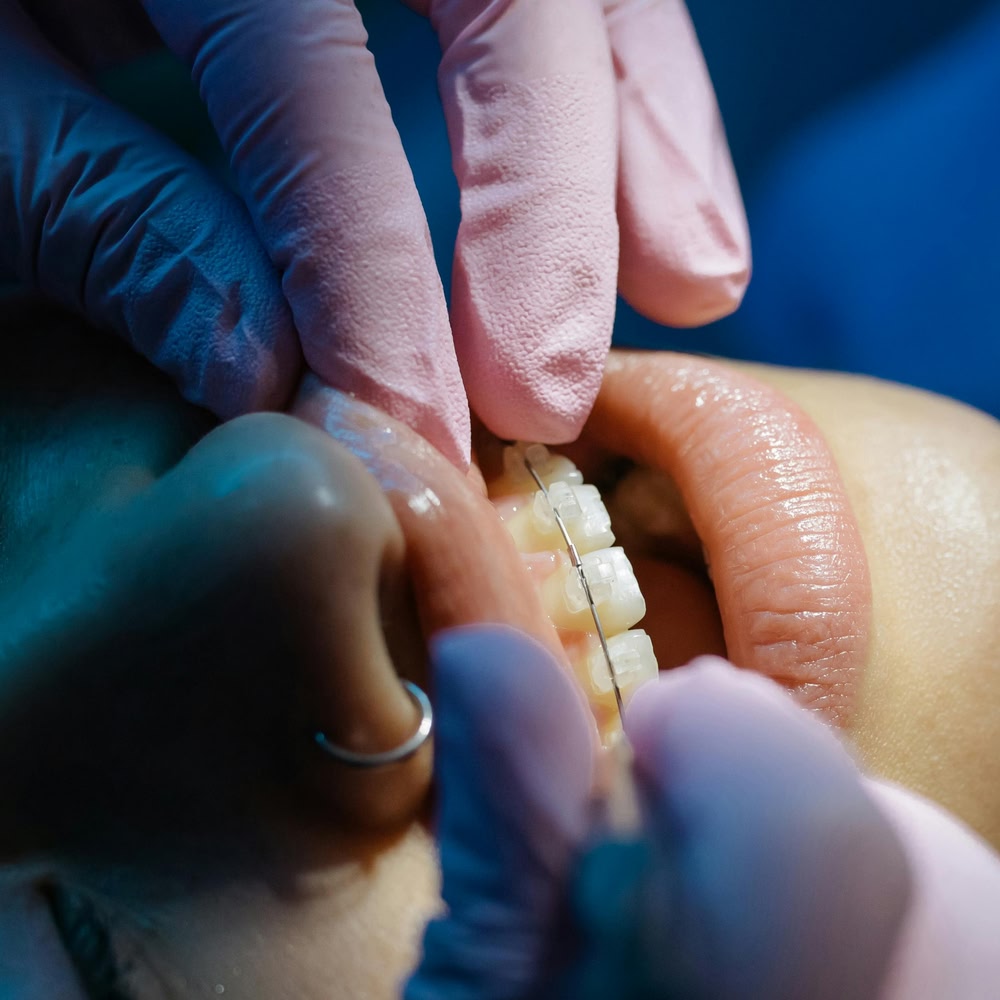 Braces For Upper Teeth / Top Teeth – Smile White UK