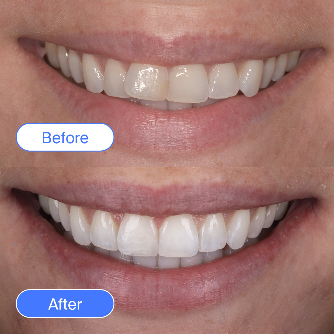 Clear Aligners | Teeth Straightening – SmileWhite UK