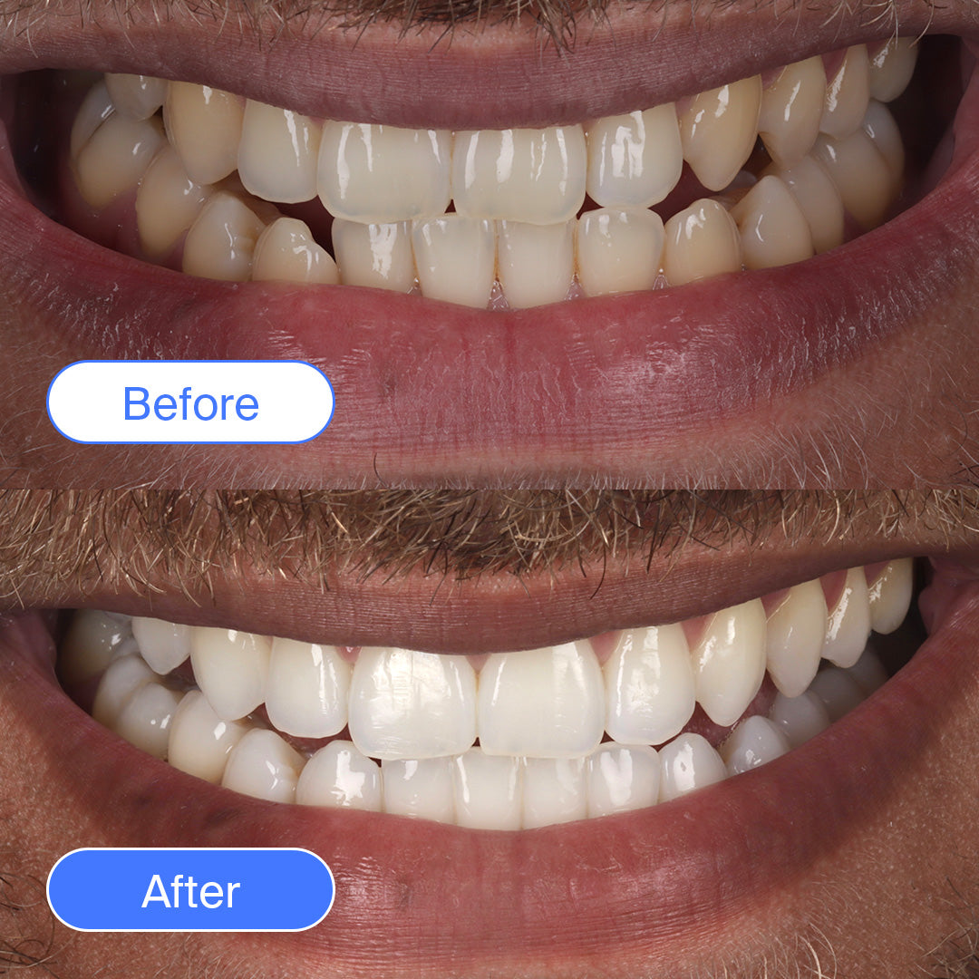 Clear Aligners | Teeth Straightening – SmileWhite UK