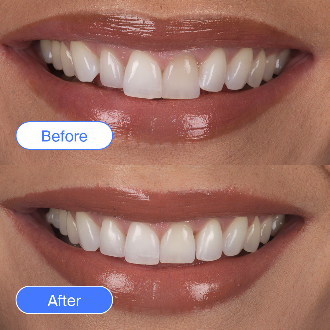Clear Aligners | Teeth Straightening – SmileWhite UK