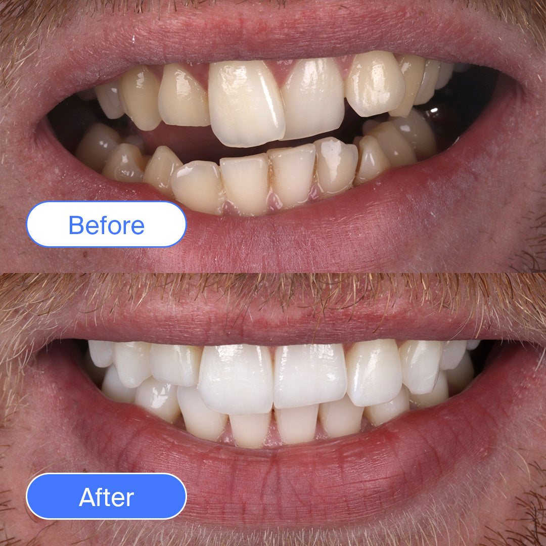 Clear Aligners | Teeth Straightening – SmileWhite UK