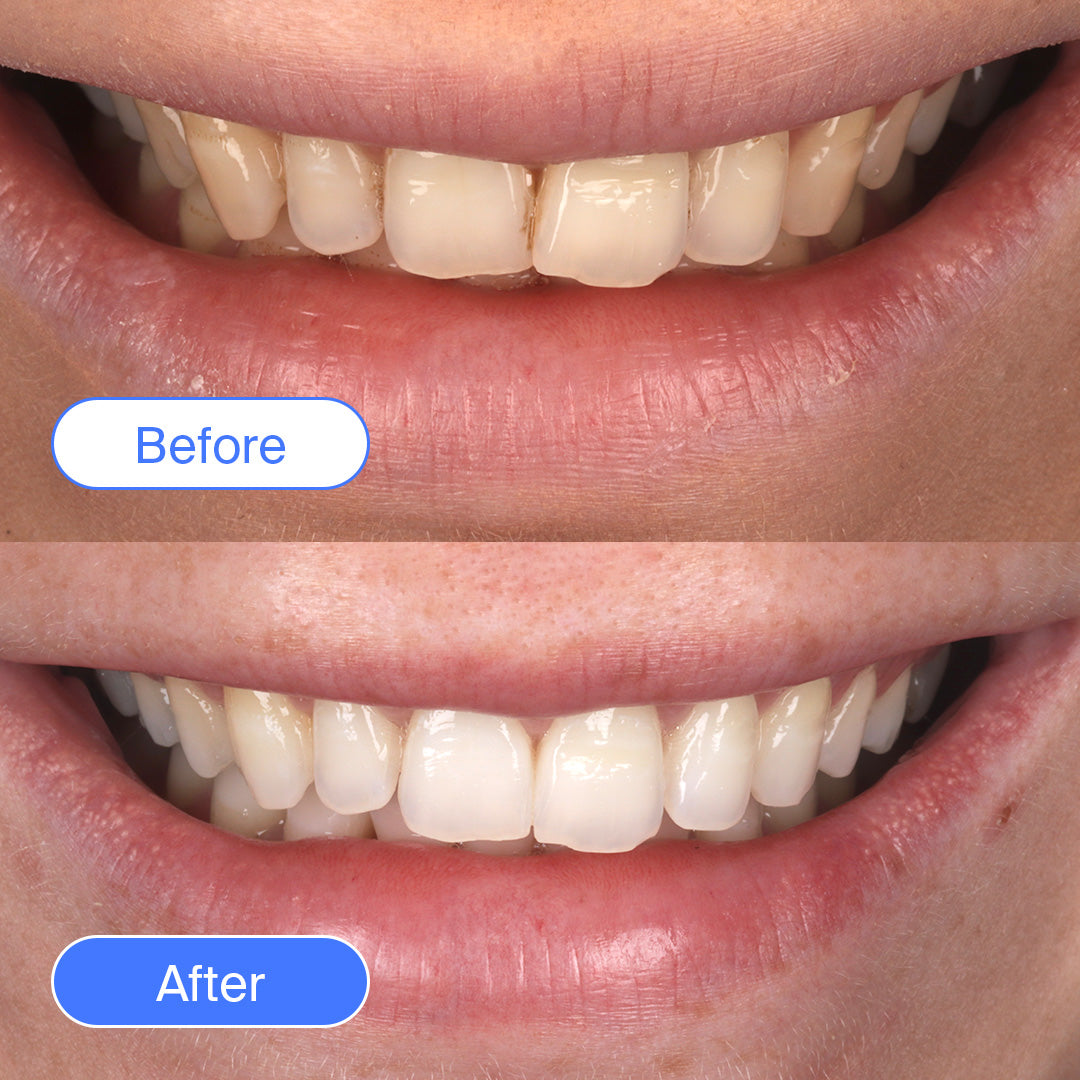 Clear Aligners | Teeth Straightening – SmileWhite UK