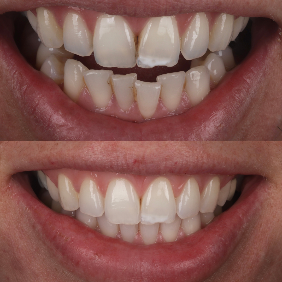 Clear Aligners | Teeth Straightening – Smile White – SmileWhite UK