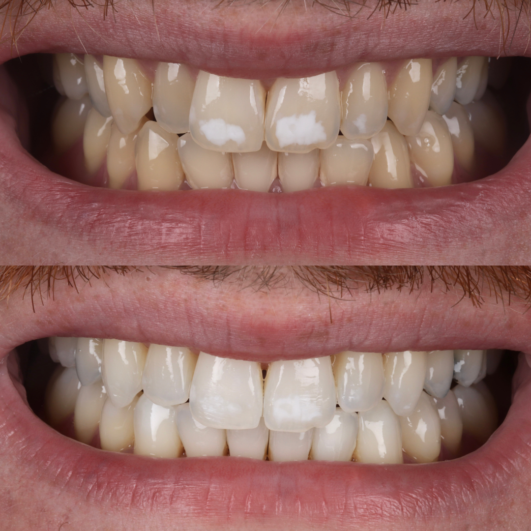 Clear Aligners | Teeth Straightening – Smile White – SmileWhite UK
