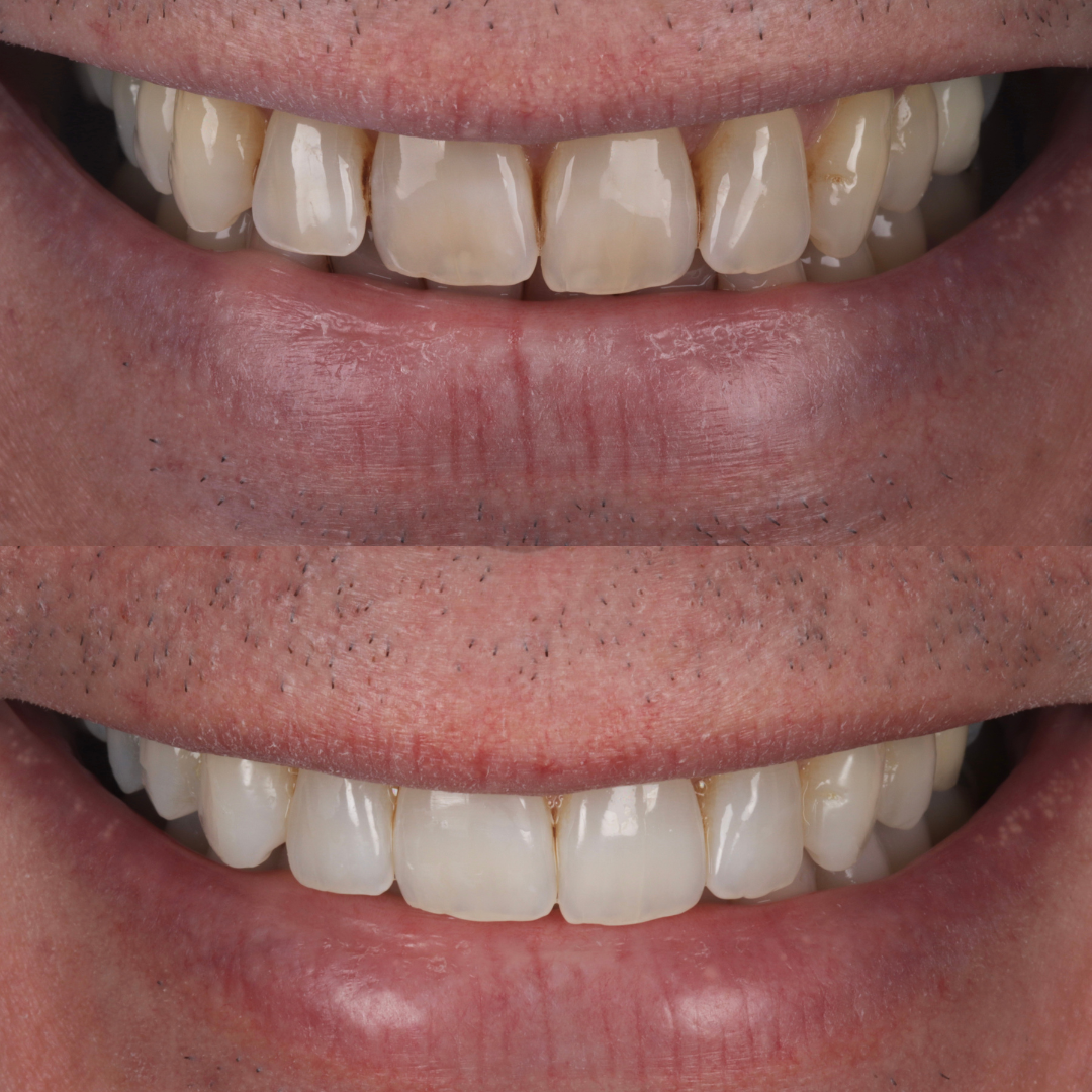 Clear Aligners | Teeth Straightening – Smile White – SmileWhite UK