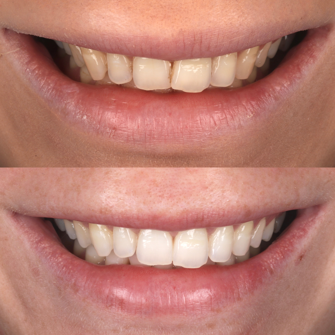 Clear Aligners | Teeth Straightening – Smile White – SmileWhite UK