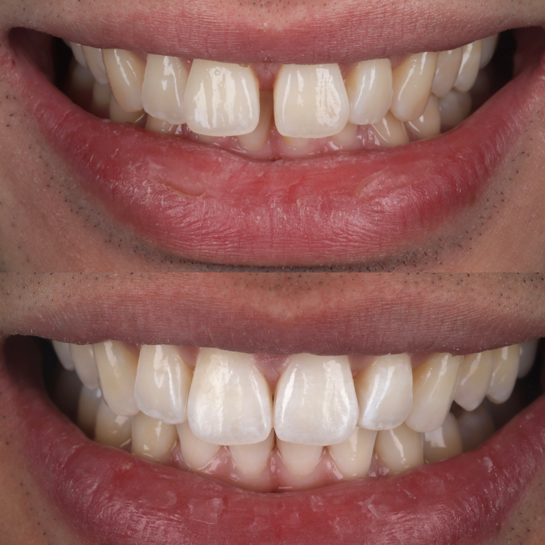 Clear Aligners | Teeth Straightening – Smile White – SmileWhite UK