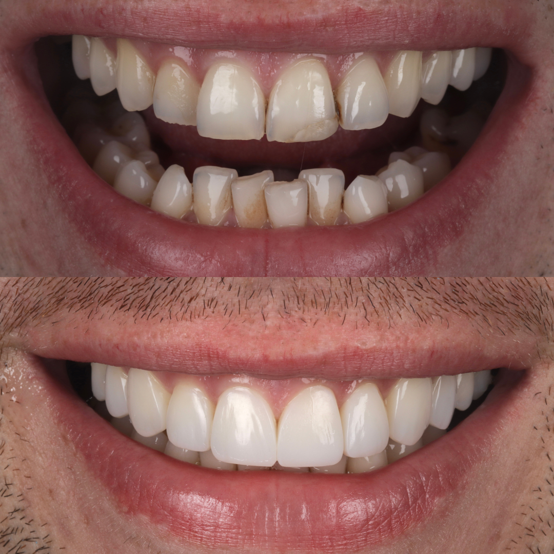 Clear Aligners | Teeth Straightening – Smile White – SmileWhite UK