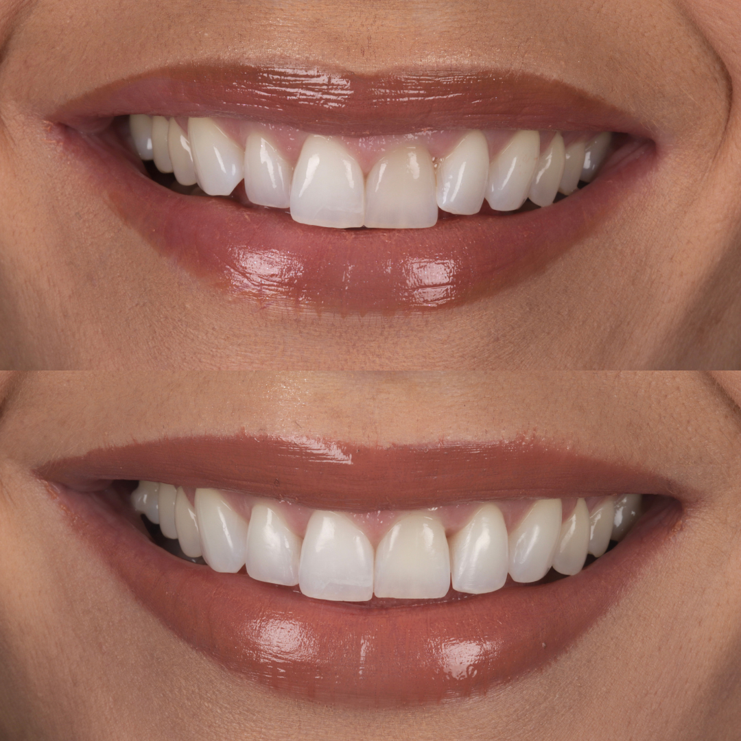 Clear Aligners | Teeth Straightening – Smile White – SmileWhite UK